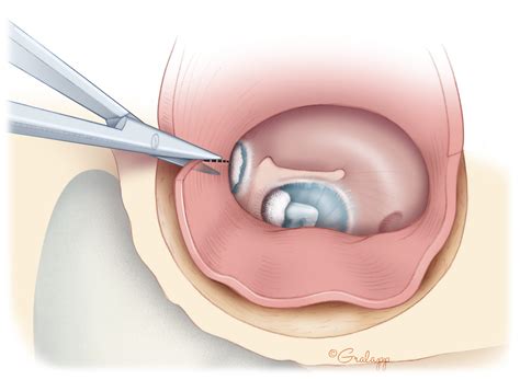 Canal Wall Down Mastoidectomy Oto Surgery Atlas