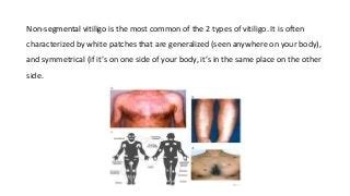 Vitiligo Types Symptoms Causes Treatment And Recovery Iq Learning Pptx