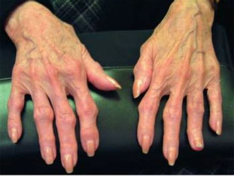 Bouchards Nodes Medizzy