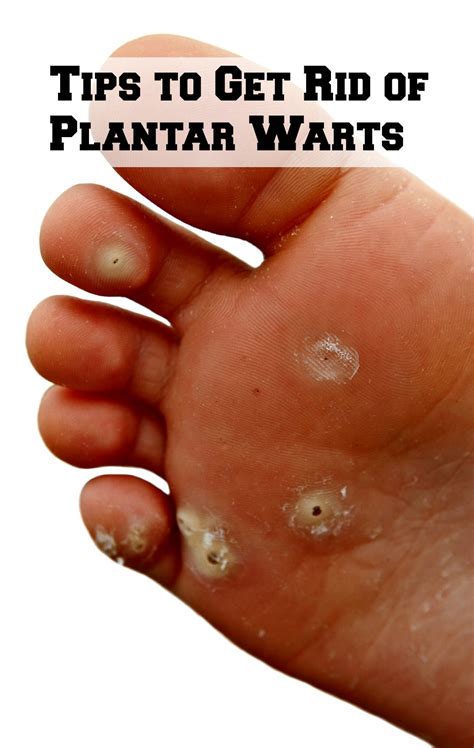 Stages Of Plantar Wart Removal Plantar Wart Removal Duct Tape When Skin Cells Become