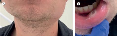 A Case Of Parotitis Caused By Hmpx Virus The Lancet