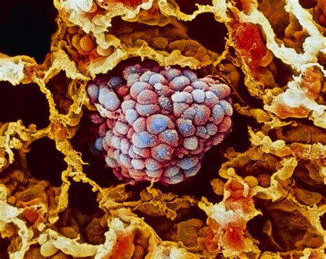Inoperable Lung Cancer Associated With Longer Survival Under Combined