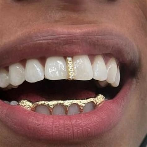 Permanent Gold Teeth History Cost Pros Cons Artofit