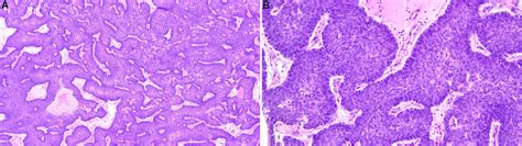 Basaloid Carcinoma Cords A 2× Of Hyperchromatic Cells With Round To Download Scientific