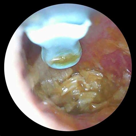 Eardrum Looking Like A Bad Beef Chow Mein Rearwax