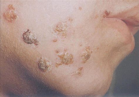 脓疱疮 临床实用皮肤病性病图谱