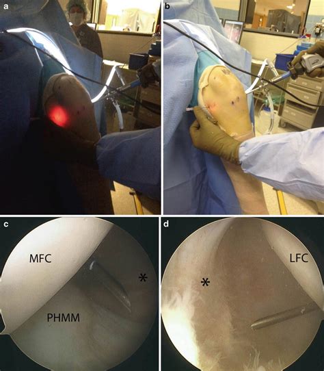 Diagnostic Knee Arthroscopy And Arthroscopic Anatomy Radiology Key