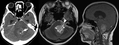 The Different Shapes Of The Fourth Ventricle Clinical Radiology