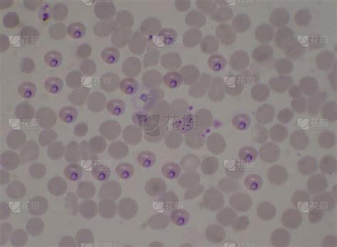疟疾血液寄生虫感染红细胞的医学概念。