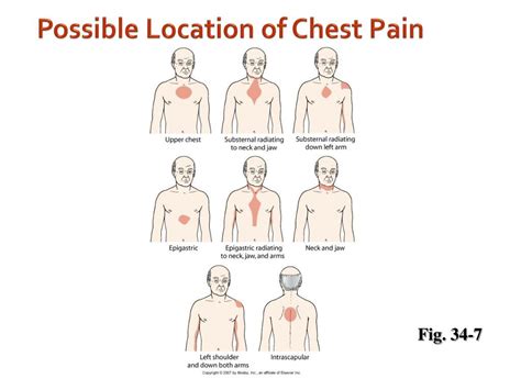 Ppt Focus On Coronary Artery Disease And Acute Coronary Syndrome