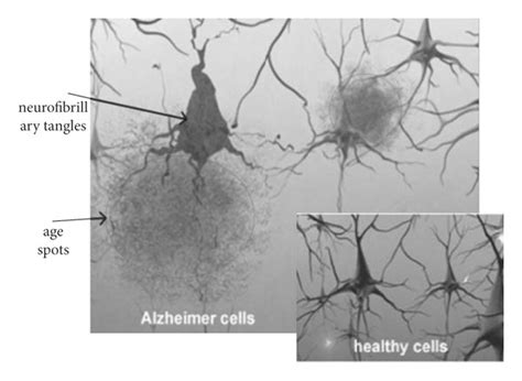 Schematic Diagram Of Senile Plaques And Neurofibrillary Tangles A Download Scientific