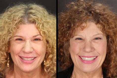 Worn Down Teeth Causes And Treatment • Aesthetic Smile Designs