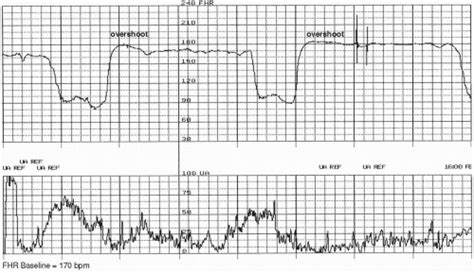 Fetal Heart Rate Pattern Interpretation Obgyn Key