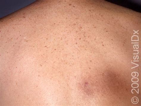 Brown Spots On Skin On Back