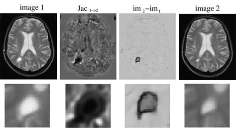Application Of The Jacobian To A Real Case We Can See A Lesion That