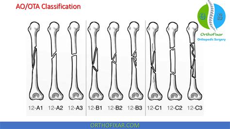 Humeral Shaft Fractures