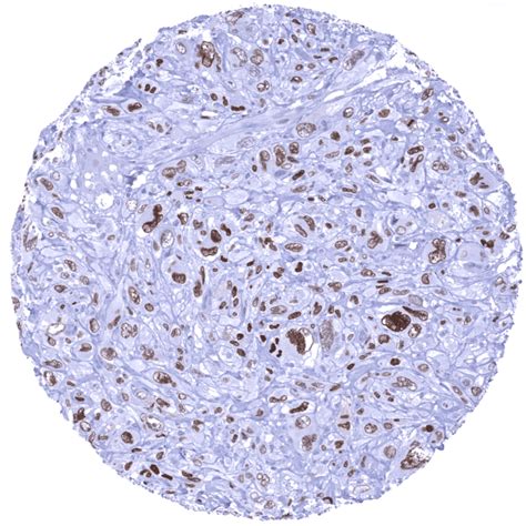 Cancer Tissue Gallery Satb2 Ms Validated Antibodies