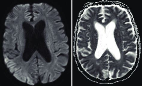 Multimodal Cerebral Mri Of The Presented Patient Shows A Typical