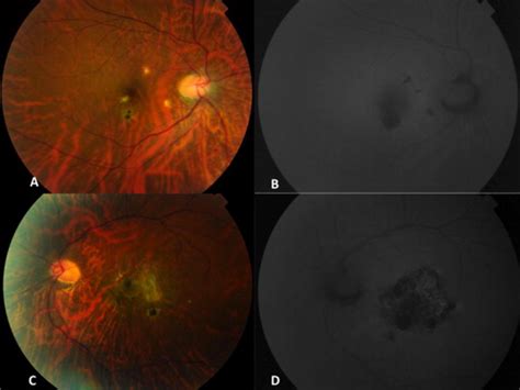 Fundus Photograph Of The Right Eye Showing Choroiditis Patches In A