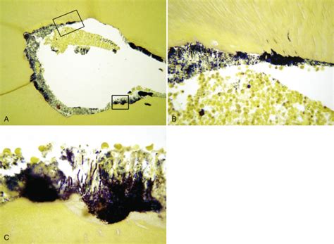 Microbiology Of Endodontic Infections Pocket Dentistry