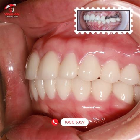 Abutment Implant Là Gì Tìm Hiểu Vai Trò Phân Loại Và Chi Phí
