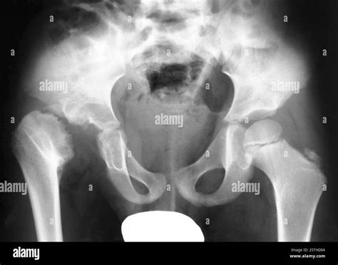 Hip Disease X Ray Of The Pelvis Of A Patient With Osteochondritis