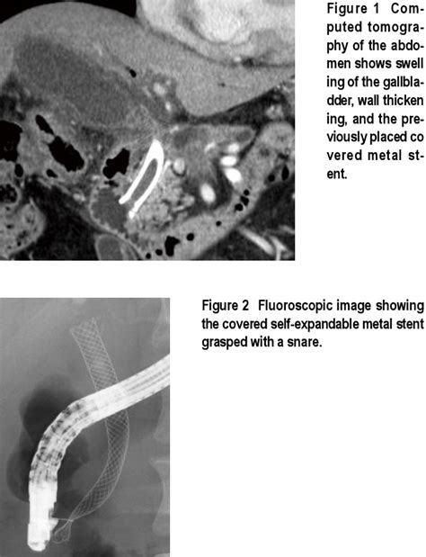 Figure 1 From Endoscopic Transpapillary Gallbladder Drainage With Replacement Of A Covered Self