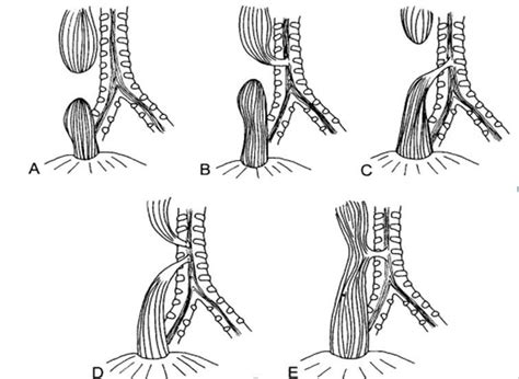 The Classification Of The Esophageal Atresia Download Scientific Diagram