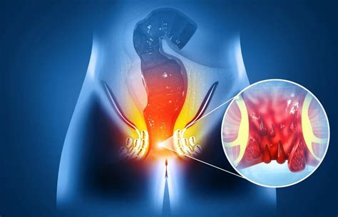 Internal Or External Hemorrhoids Which Type Do I Have Betsy F Clemens M D Board Certified