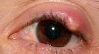 Eyelid Bump Symptoms Causes And Treatments