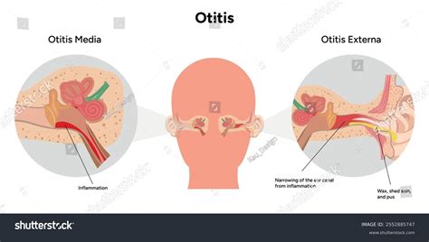 Otitis Media Externa Inflammation Anatomy Human Stock Vector Royalty Free 2552885747