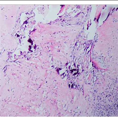 Walch Classification Of Glenoid Morphology In Primary Glenohumeral Download Scientific Diagram
