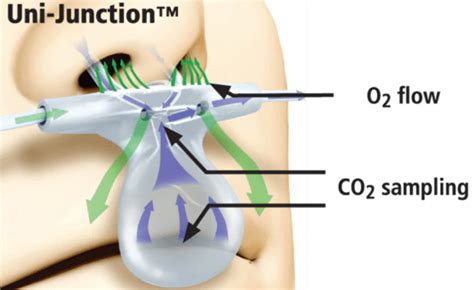 Etco2 Detection Via Nasal Cannula Kinnetic Medicine