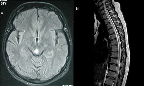 Dorsal Midbrain Involvement In Mri As A Core Clinical Manifestation For