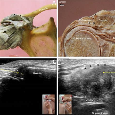 Ultrasound Guided Injection For The Suprascapular Nerve Notes A