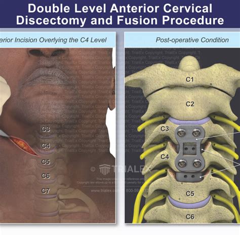 4 Level Posterior Lumbar Interbody Fusion