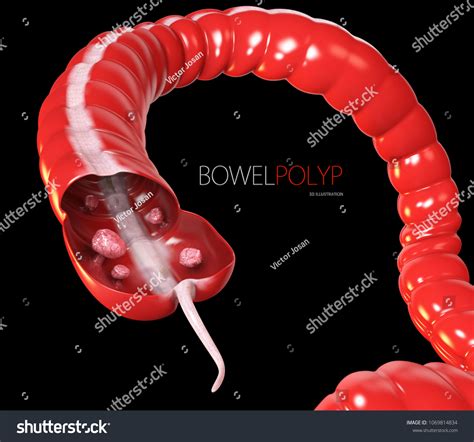 Colon Polyps 3d Illustration Polyp Intestine ภาพประกอบสต็อก 1069814834 Shutterstock