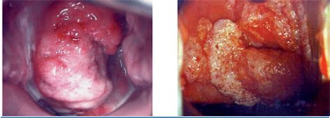 Cervical Lesions Colposcopy Refhelp