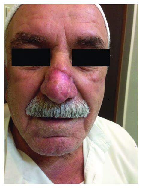 Large Rhinophyma Treated By Surgical Excision And Electrocautery Pmc