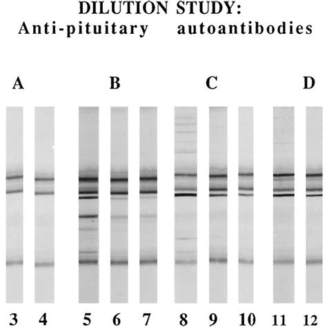 Radiological Appearance Of Xanthomatous Hypophysitis On Mri The