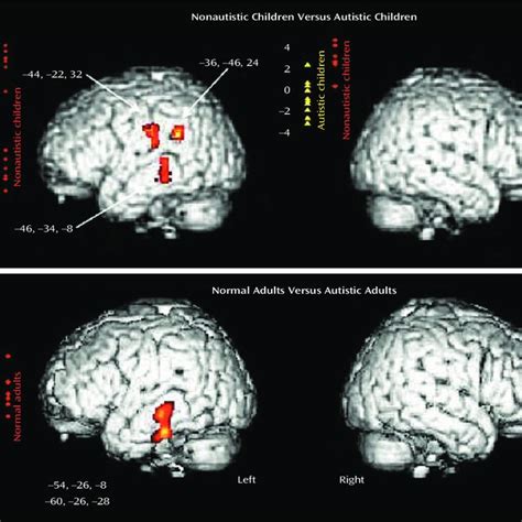 Pdf Perception Of Complex Sounds In Autism Abnormal Auditory