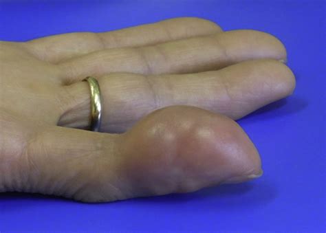 Synovial Cyst At The First Visit Download Scientific Diagram