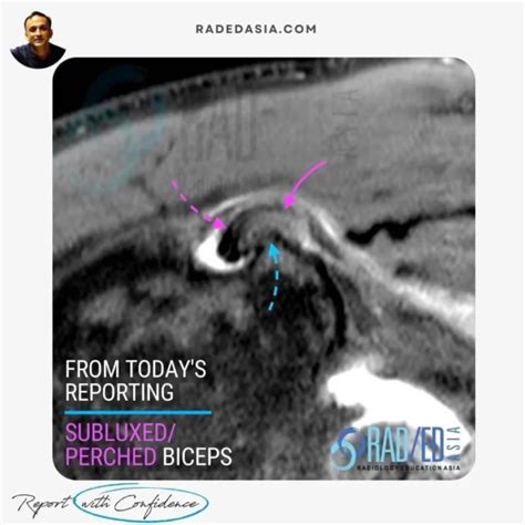 Mri Of Subscapularis Tears Atrophy Fatty Infiltration And Biceps Dislocation Radiology
