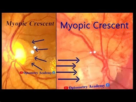 Scleral Crescent Optic Disc