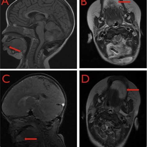 Case 2 Severe Macroglossia After Craniofacial Surgery Le Fort Iii