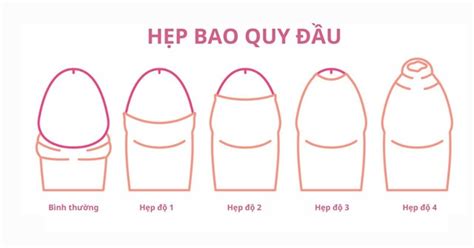 Hẹp Bao Quy đầu Những điều Cần Biết