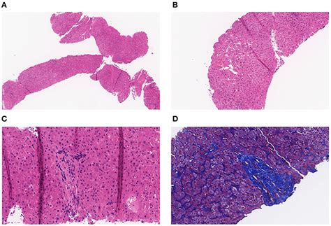 A Pathology Of The Liver Tissue He Staining X40 B Pathology Of