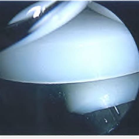 Arthroscopic Image Of Displaced Patella Component Image Taken On