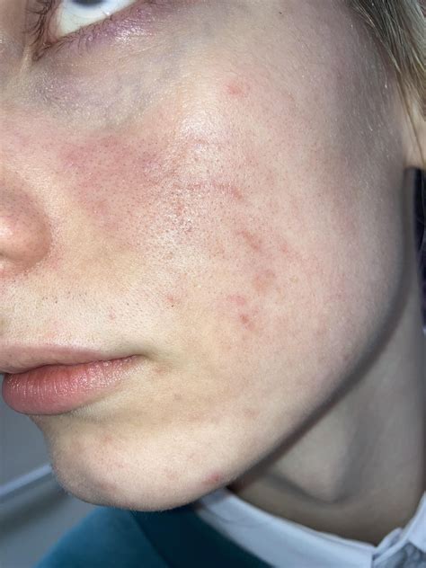Red Blotches On Face Rskin