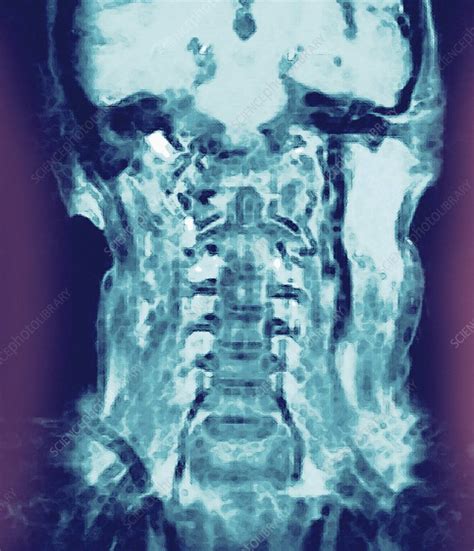 Normal Head And Neck Mri Scan Stock Image F0013011 Science